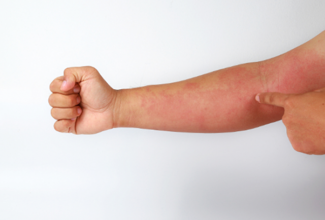 La dermatitis atópica, una enfermedad crónica con cada vez mejor ...