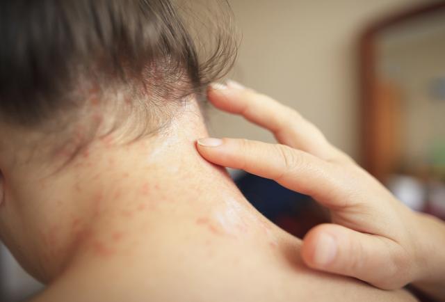 Psoriasis: Lo que debes saber sobre esta enfermedad cutánea