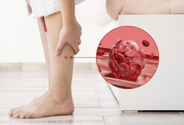 ¿Qué es la trombosis venosa profunda?