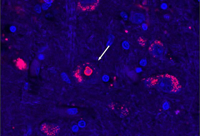 Ataxi, un mal que dificulta el caminar y mantener el equilibrio